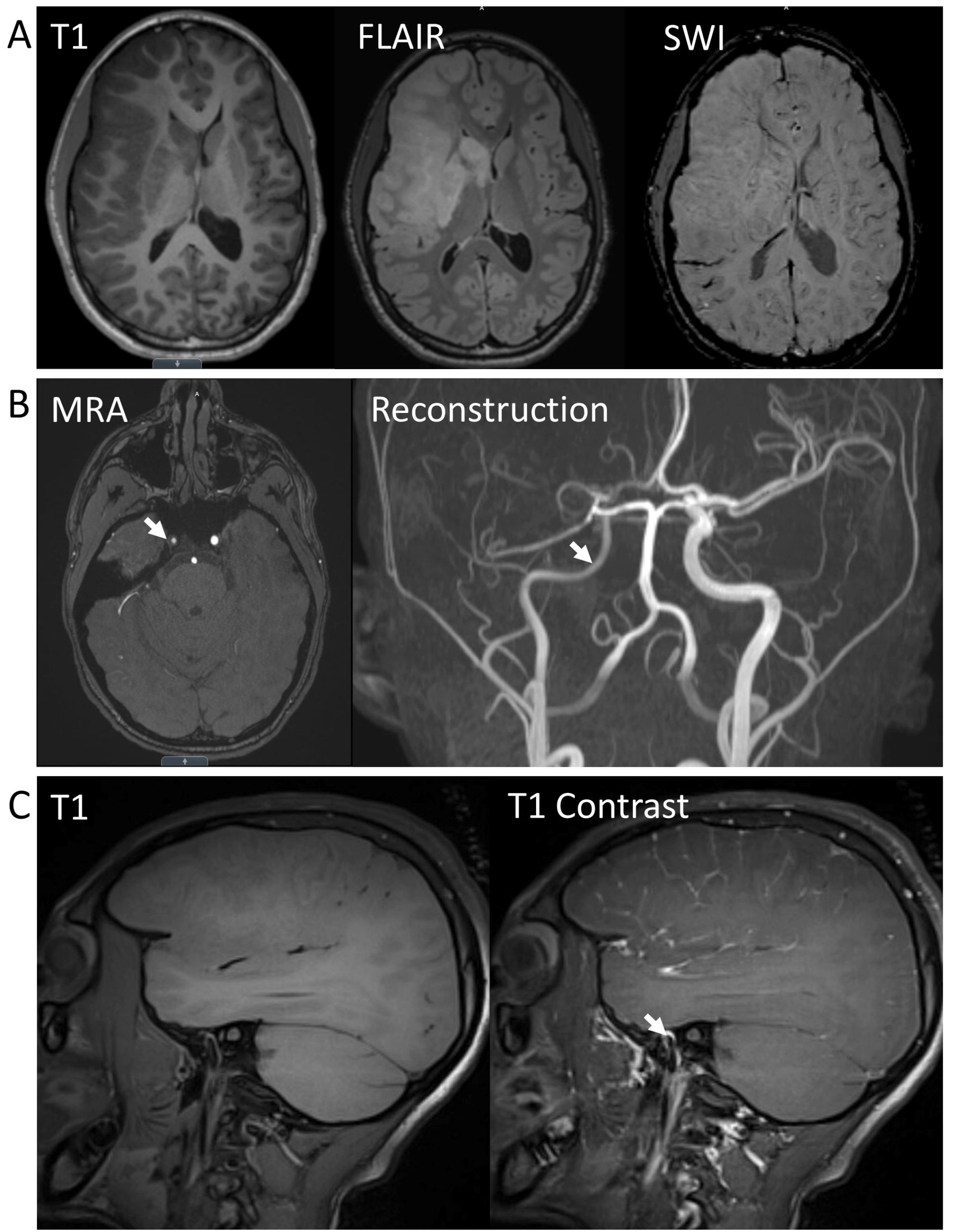 Administration of Tenecteplase Followed by Mechanical Thrombectomy in a ...
